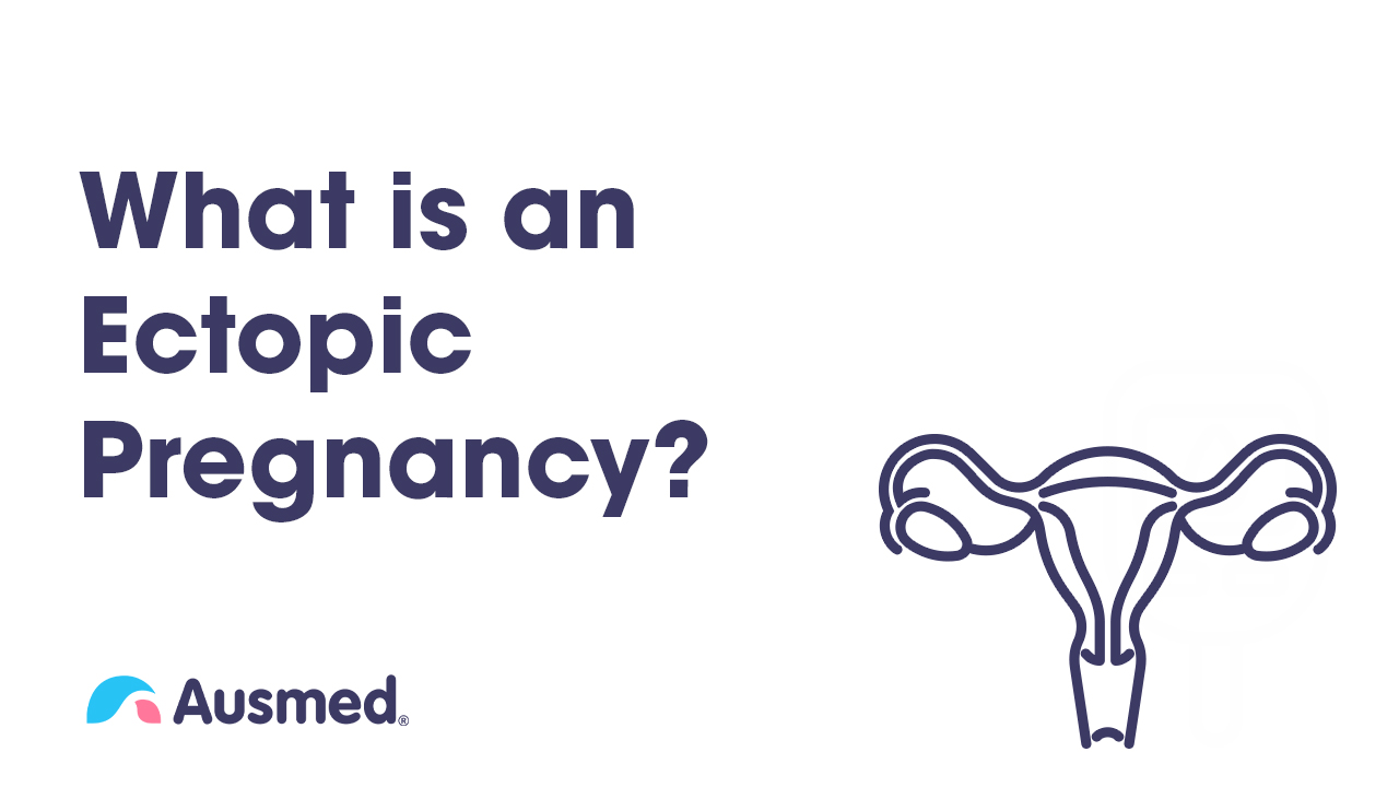 What is an Ectopic Pregnancy? | Ausmed
